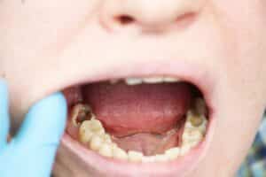 What Causes Cavities? Cavity Formation, Treatment, & Prevention